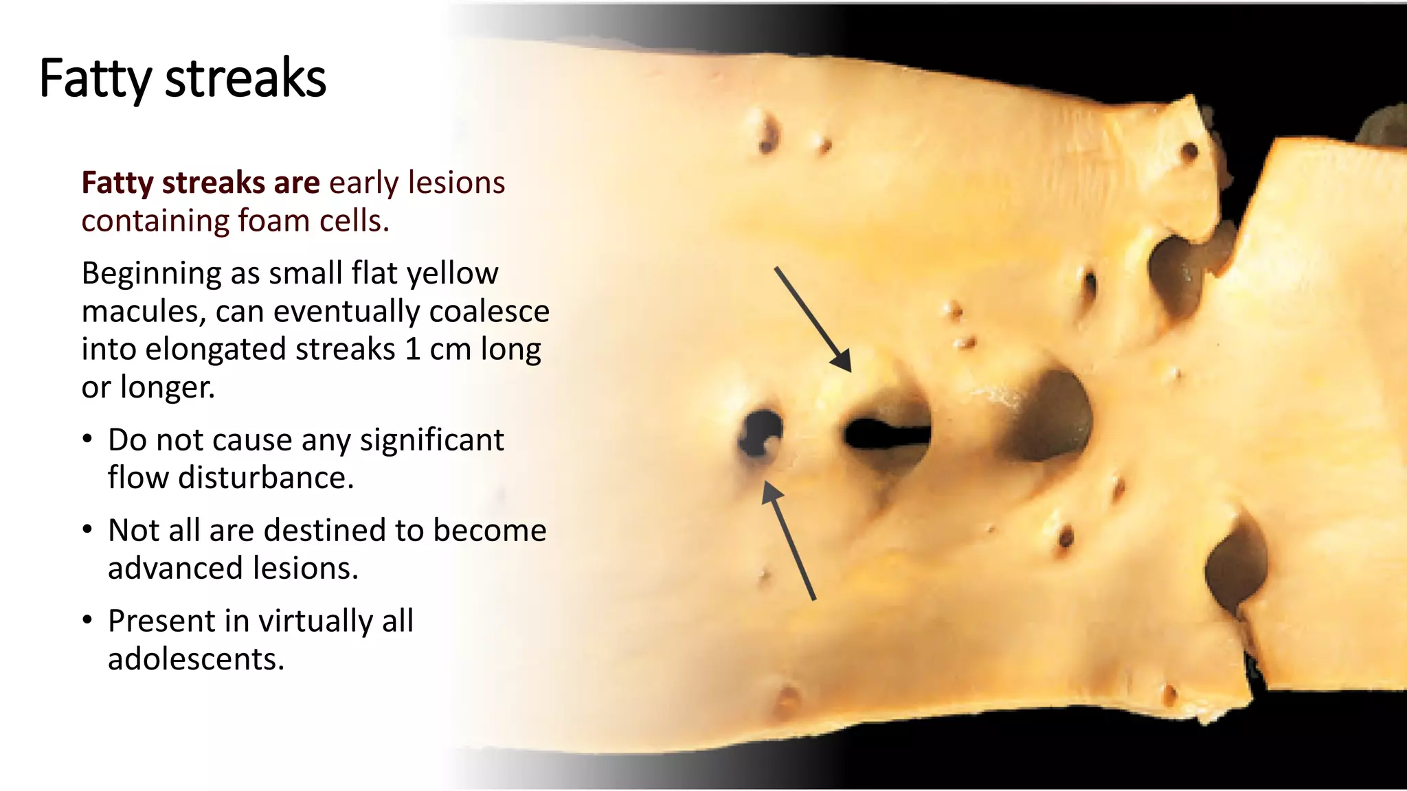 Atherosclerosis and arteriosclerosis .pdf