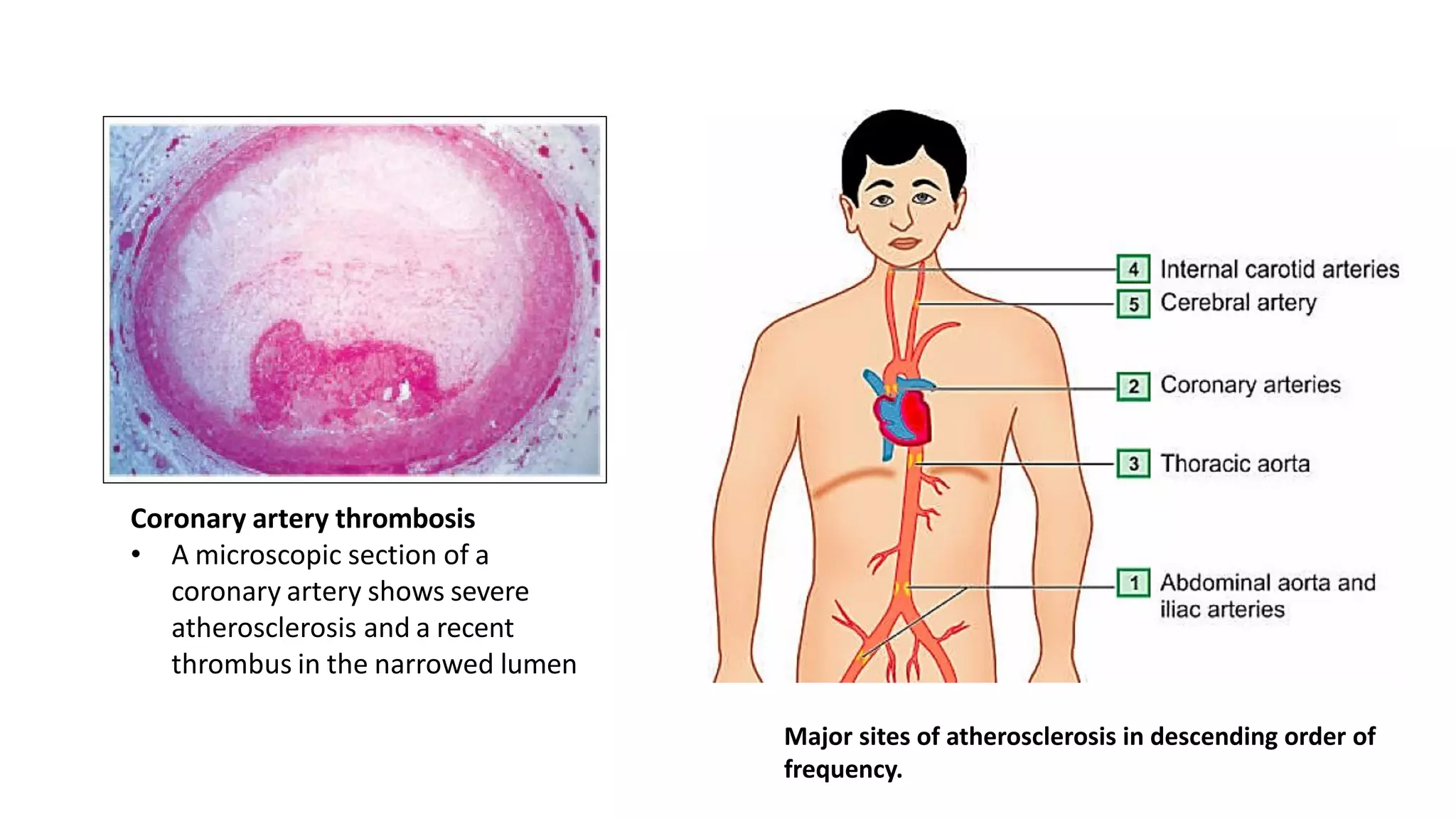 Atherosclerosis and arteriosclerosis .pdf