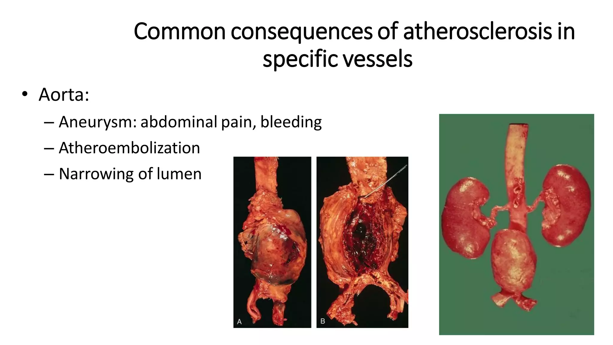 Atherosclerosis and arteriosclerosis .pdf