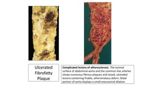 Atherosclerosis and arteriosclerosis .pdf