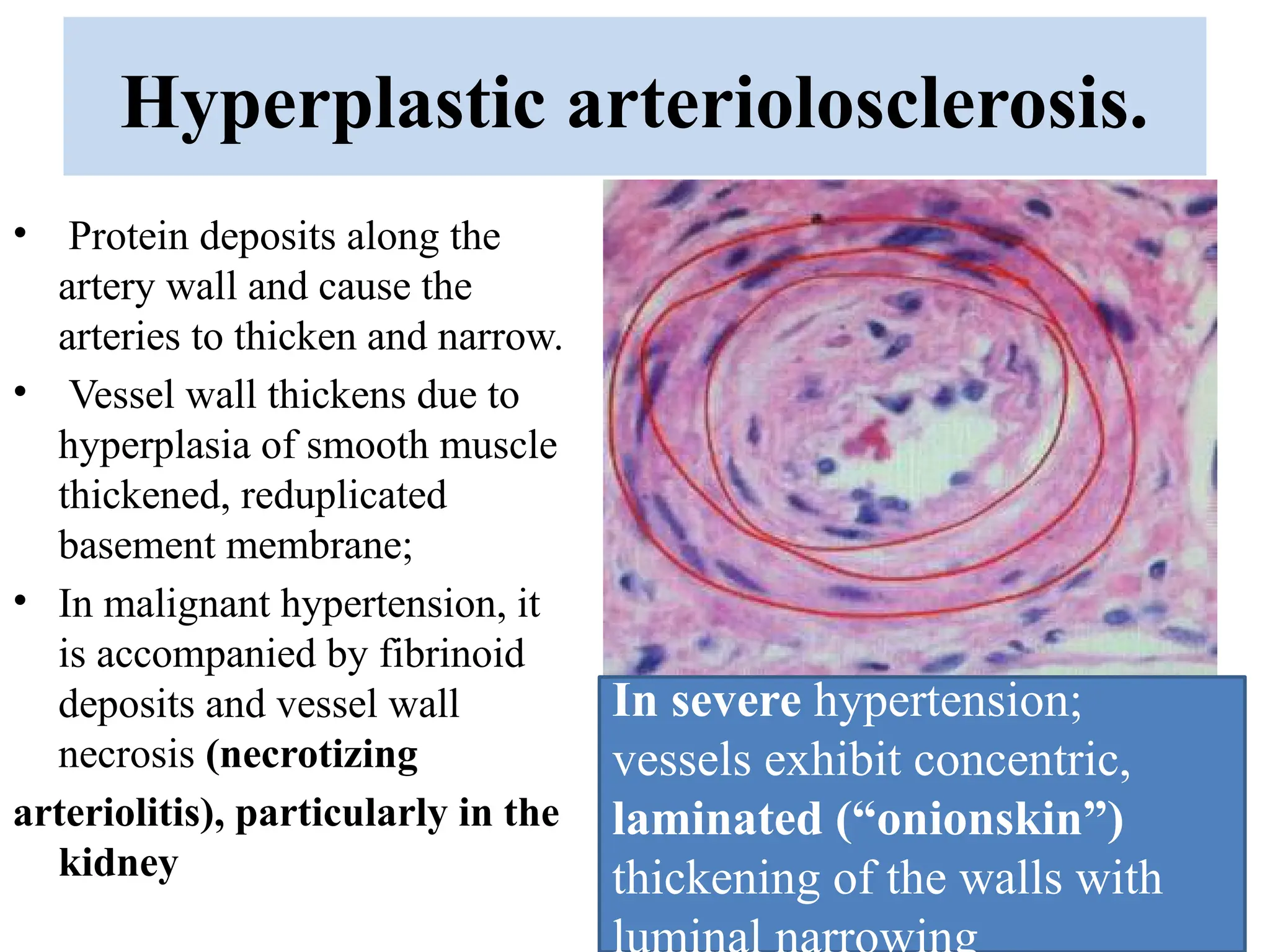 atherosclerosis pa 27 for undergraduates.pptx