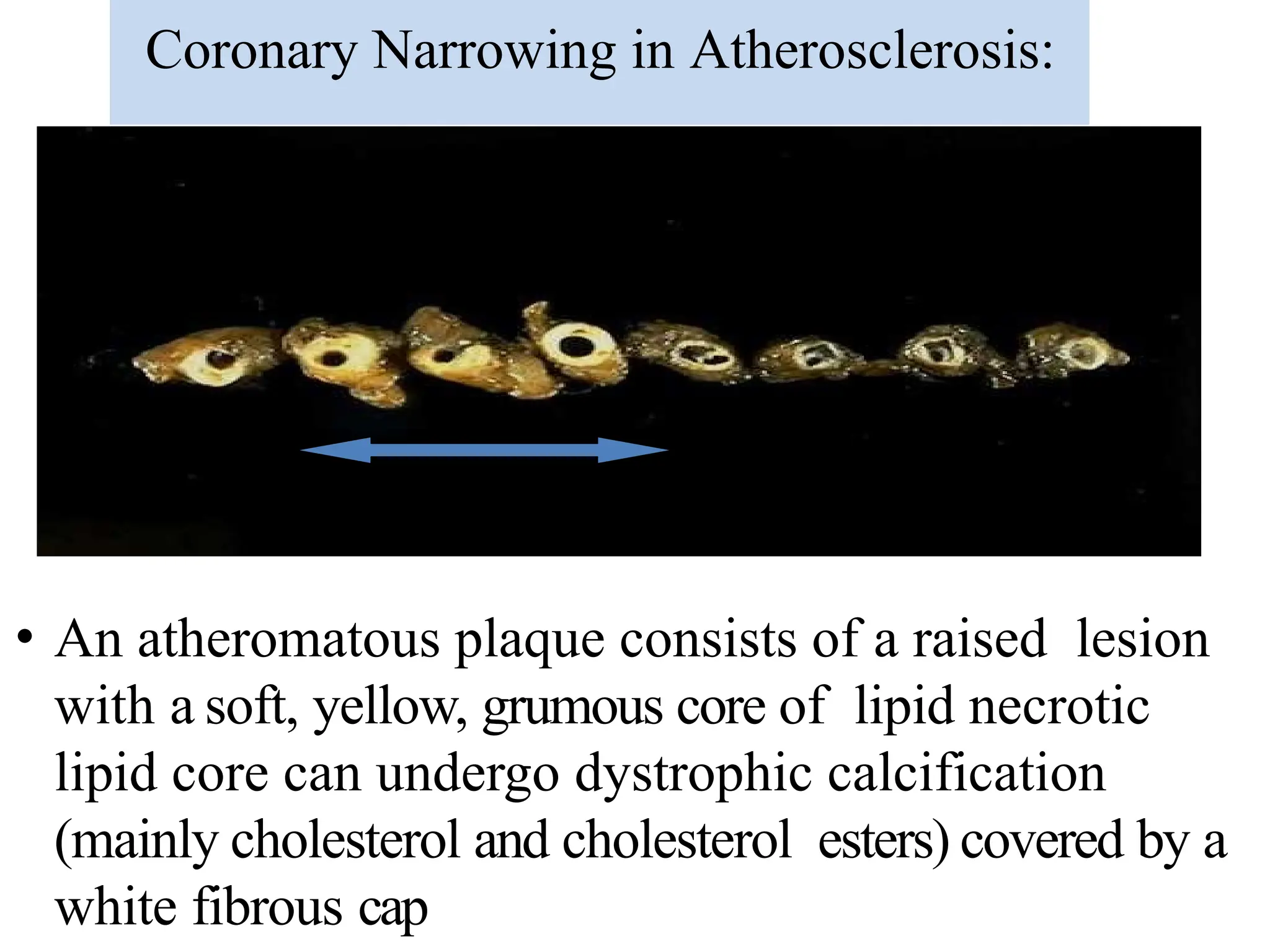 atherosclerosis pa 27 for undergraduates.pptx