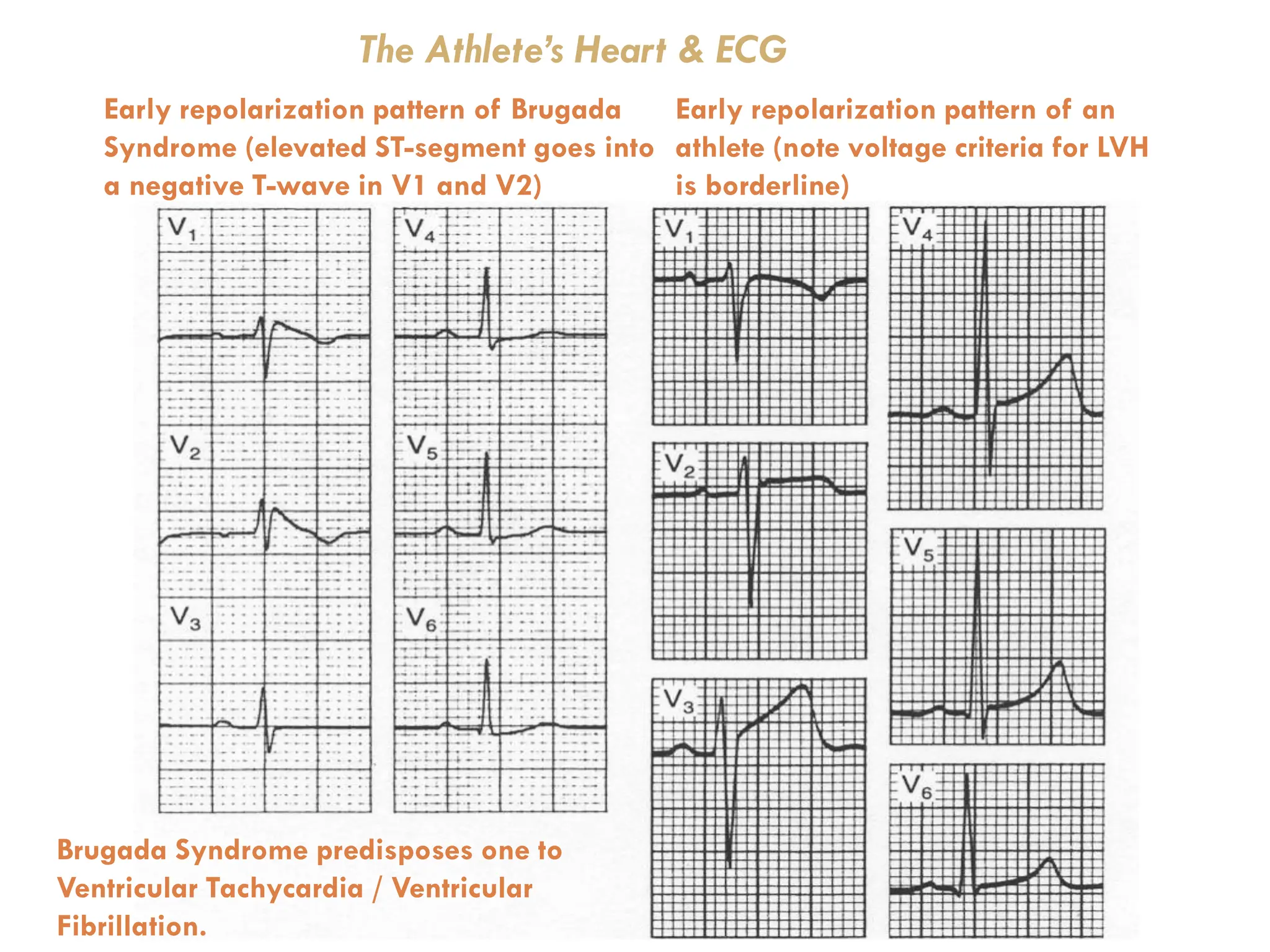 Athlete heart syndrome lecture slidessss | PDF