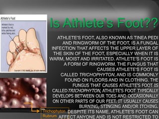 Athlete's foot | PPTX