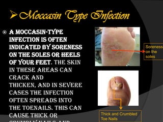 Athlete's foot | PPTX