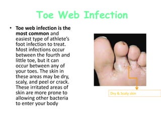 Athlete's foot | PPTX | Foot Health | Diseases and Conditions