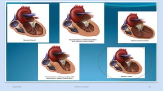 Athlete's heart | PPTX