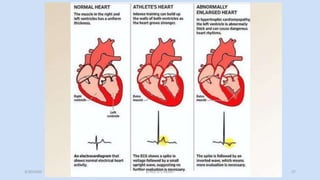 Athlete's heart | PPTX