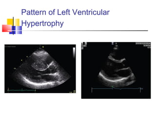 Athlete's Heart | PPT