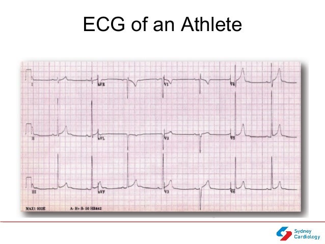 Athlete's Heart