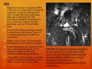 Athletic pubalgia | PPTX