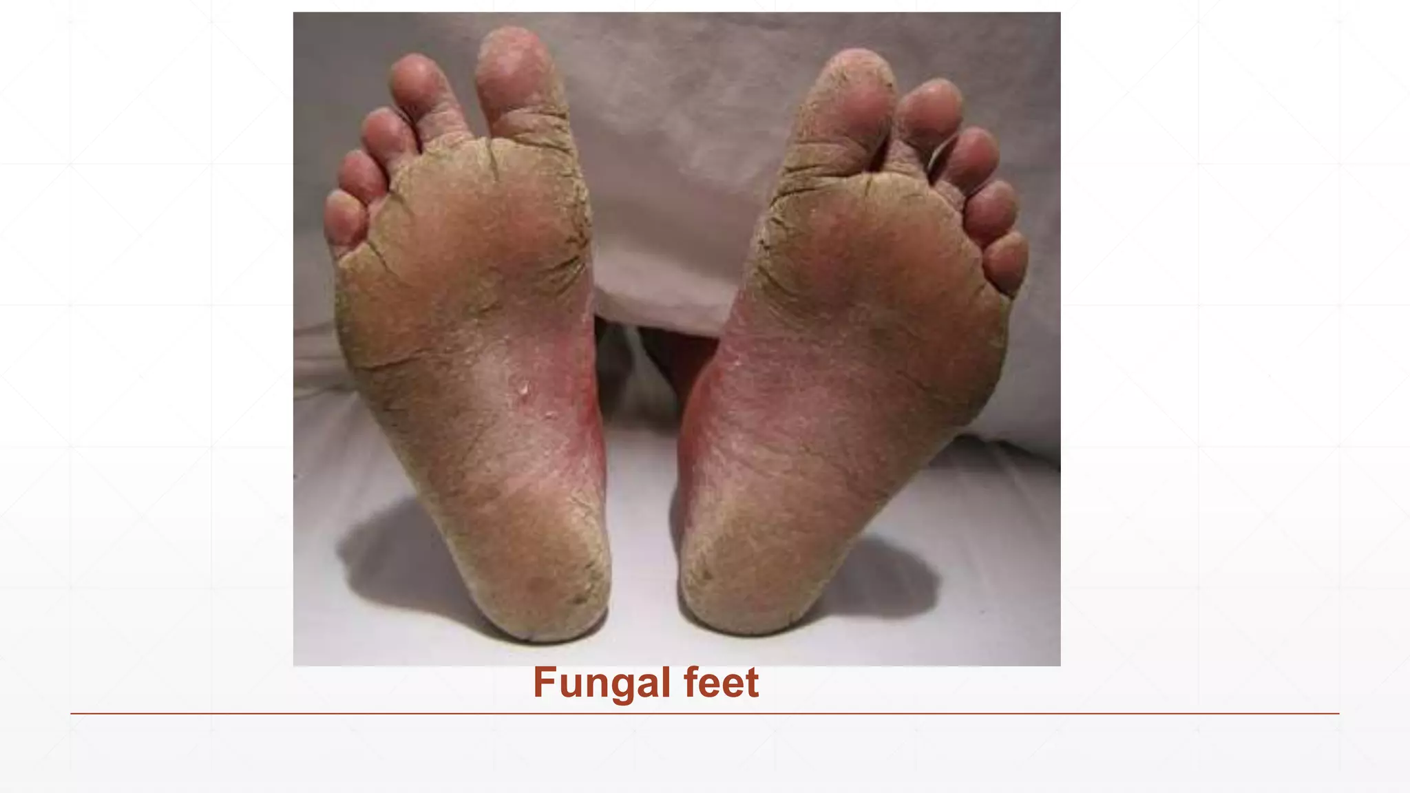 Athlets foot-treatment |management |symptoms| medical information | PPTX