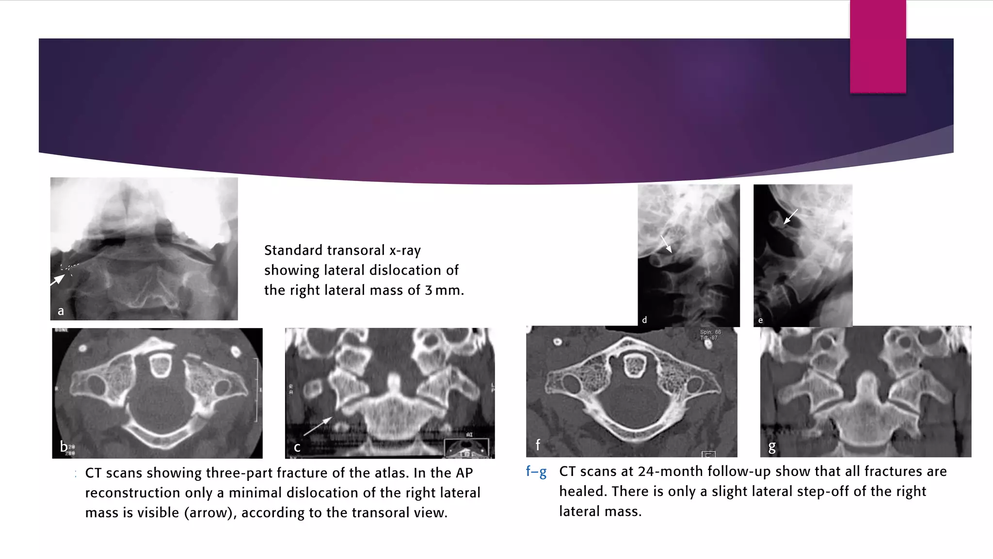 Atlantoaxial injuries | PPTX