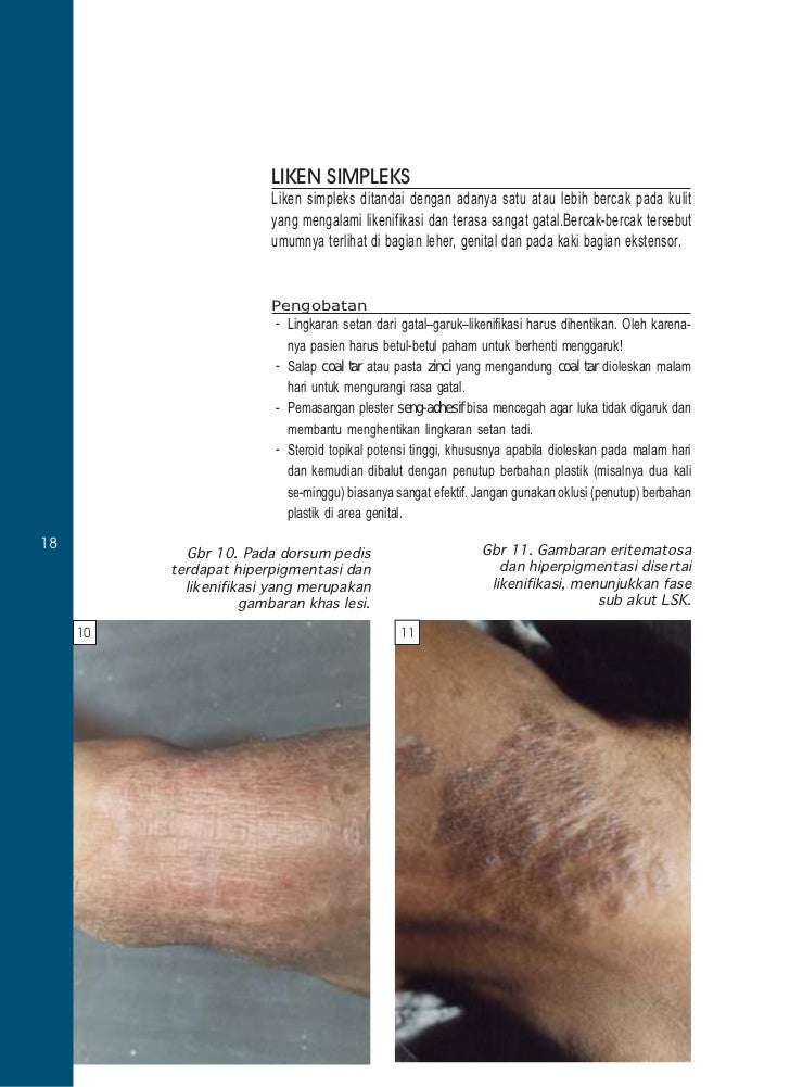 Penyakit Kulit Yang Umum Di Indonesia