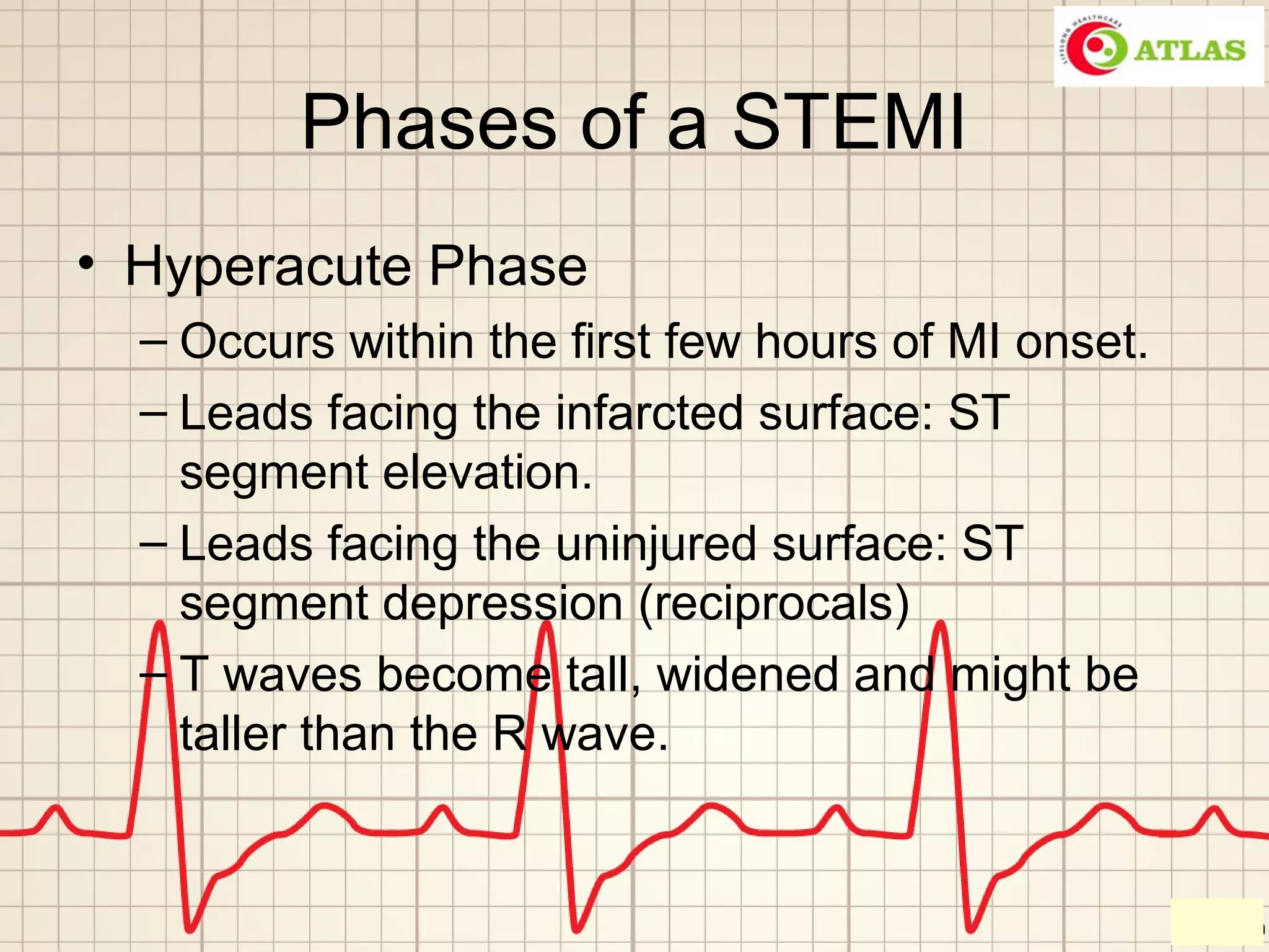 Atlas myocardialinfarction | PPT