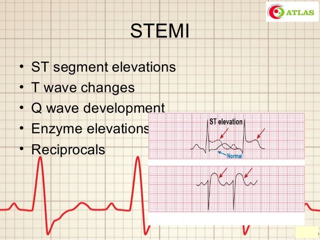 Atlas myocardialinfarction
