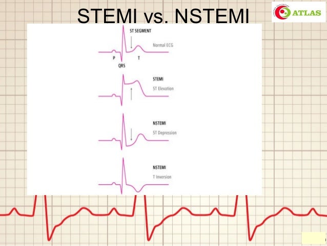 Atlas myocardialinfarction
