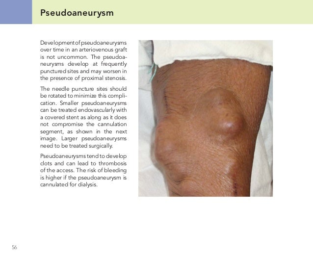 Dialysis Access Atlas