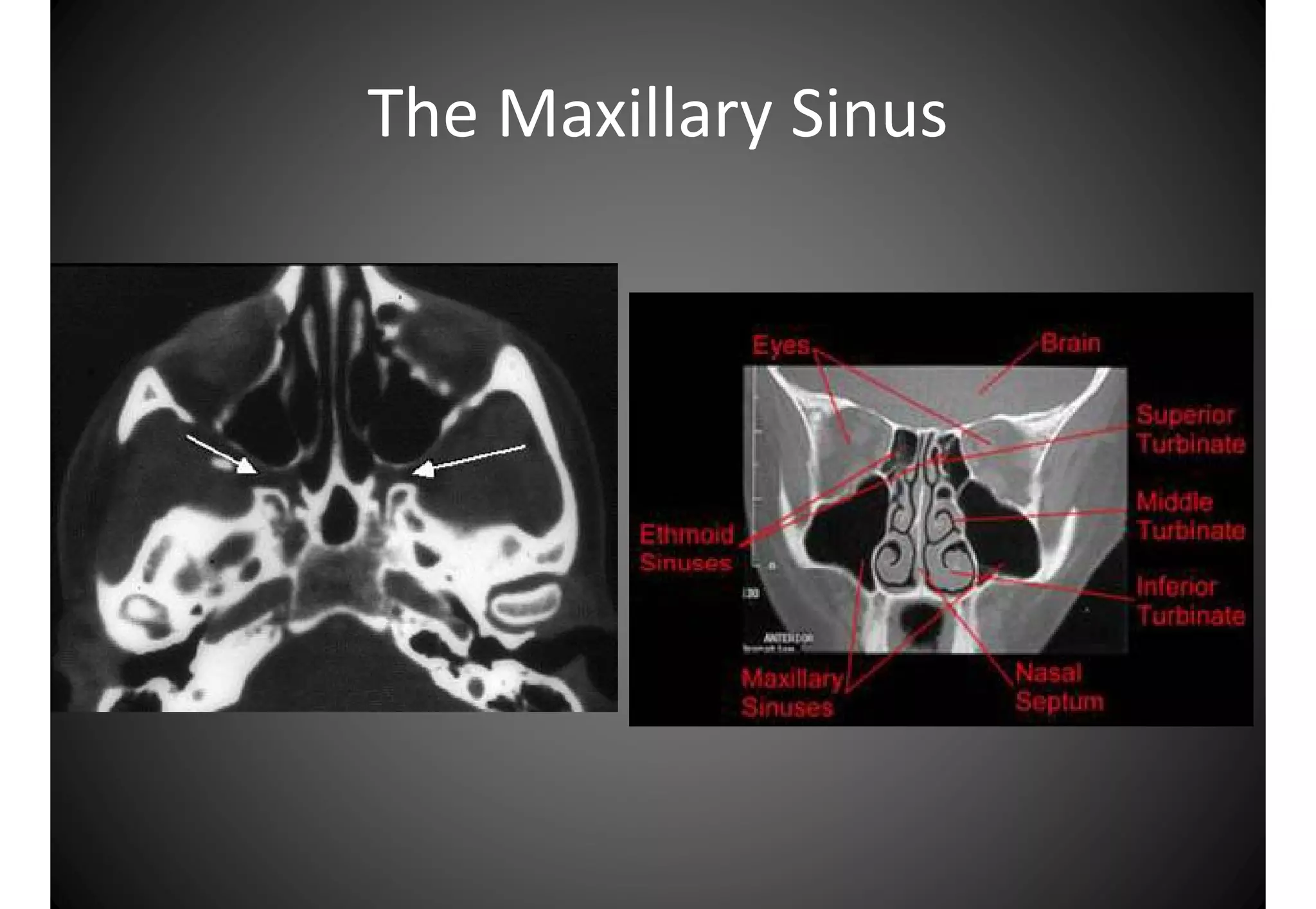 Atlas anatomy of the nose and paranasal sinuses | PDF
