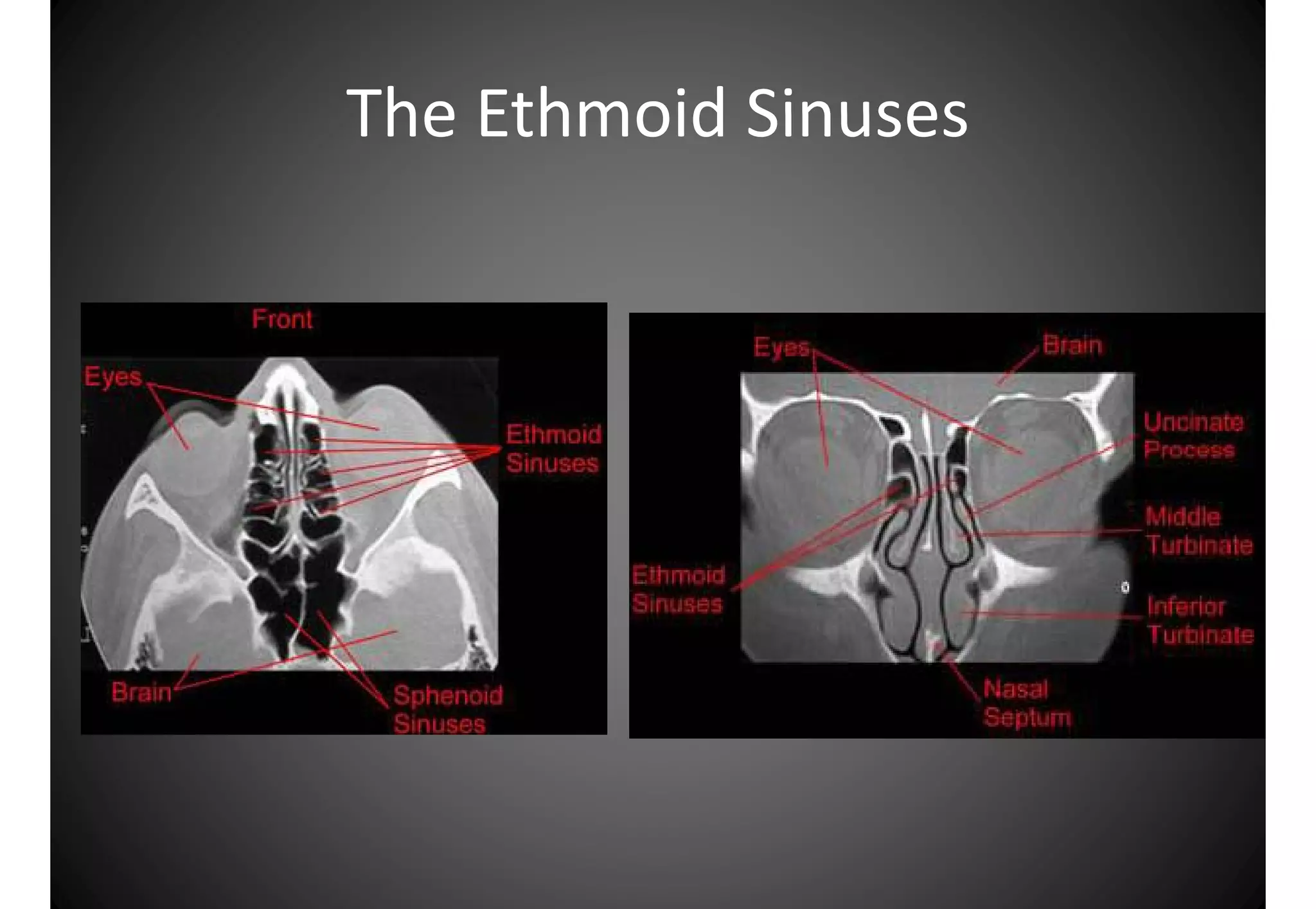 Atlas anatomy of the nose and paranasal sinuses | PDF