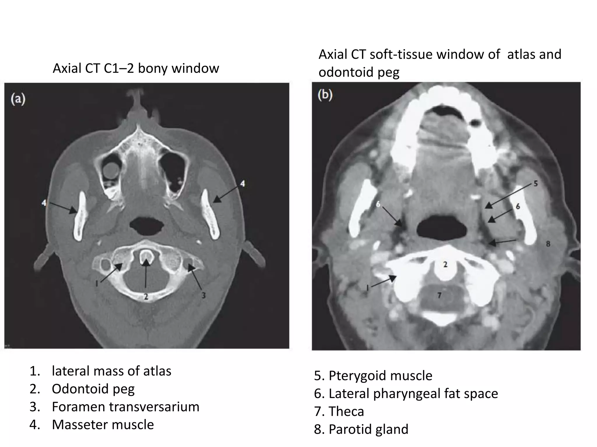 Atlas(C1) & Axis(C2) Vertebrae.pptx