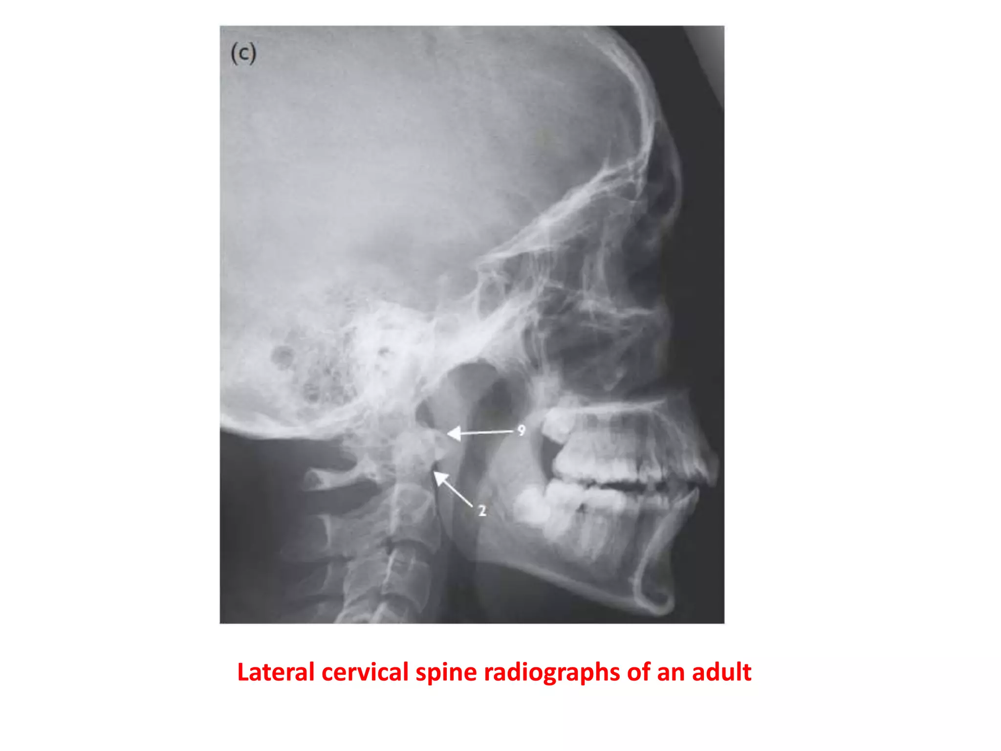 Atlas(C1) & Axis(C2) Vertebrae.pptx