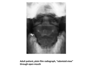 Atlas(C1) & Axis(C2) Vertebrae.pptx