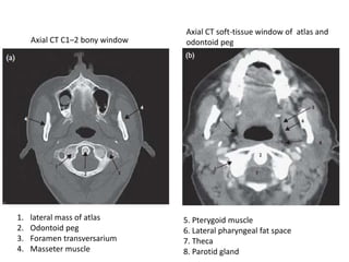 Atlas(C1) & Axis(C2) Vertebrae.pptx