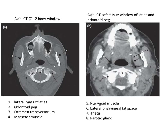 Atlas(C1) & Axis(C2) Vertebrae.pptx | Death, Injury, or Military ...