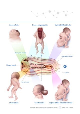 Atlas de defectos congénitos | PDF