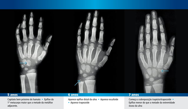 Atlas de Desenvolvimento Ósseo - Novo Nordisk 2.pdf