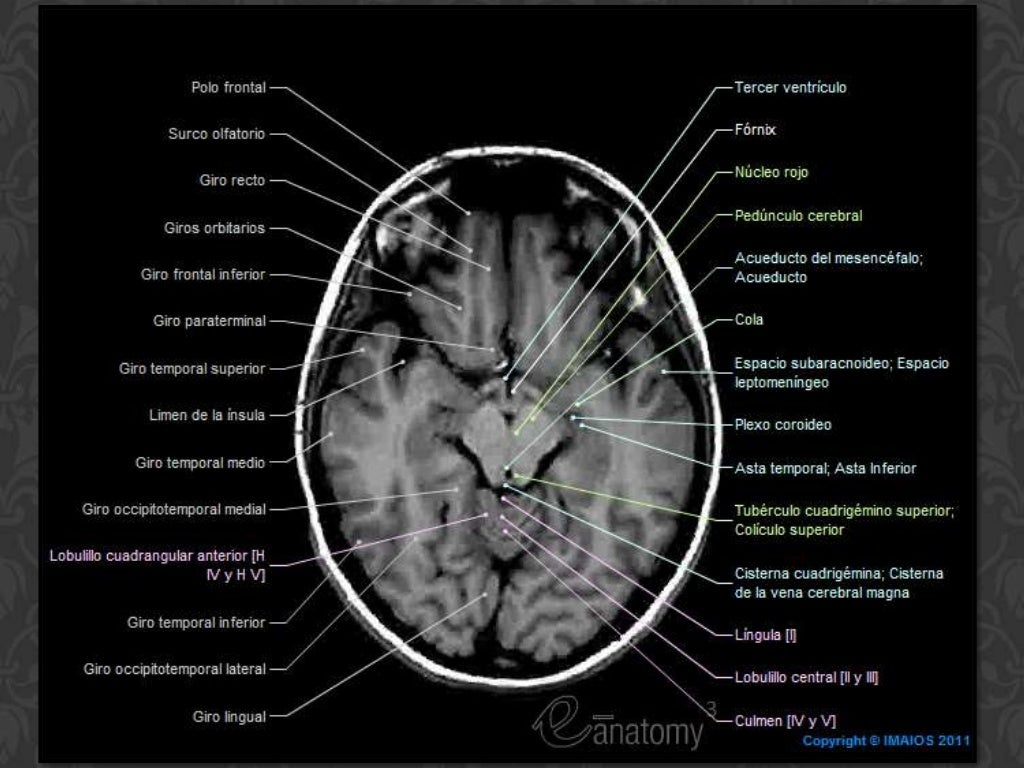 Imágenes Supratentoriales Radiología