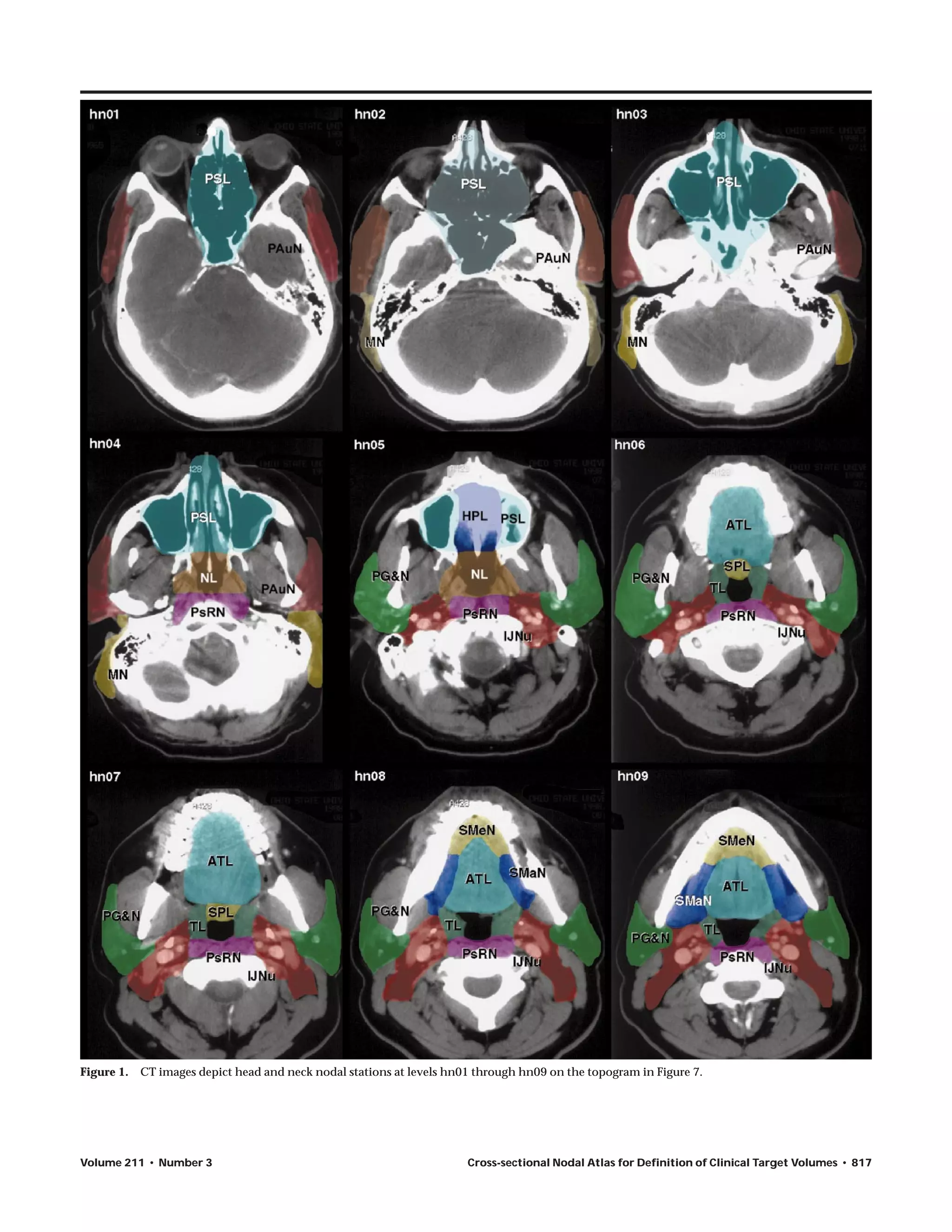Atlas drenaje ganglionar de Martínez - Monge | PDF