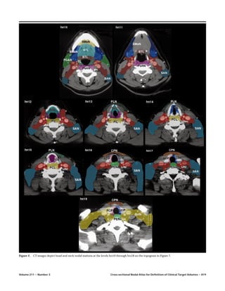 Atlas drenaje ganglionar de Martínez - Monge | PDF