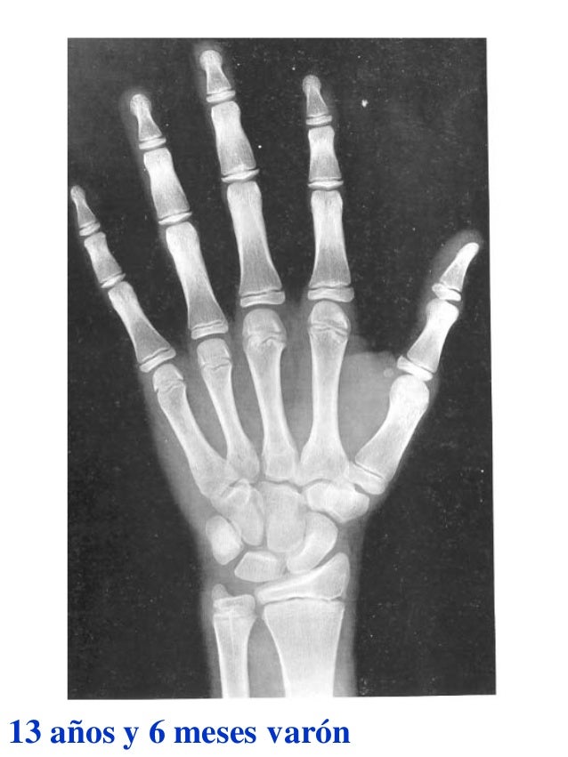 Atlas greulich y pyle