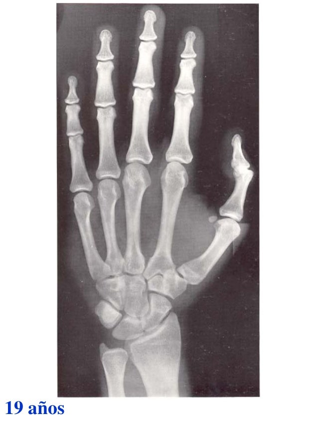 Atlas greulich y pyle