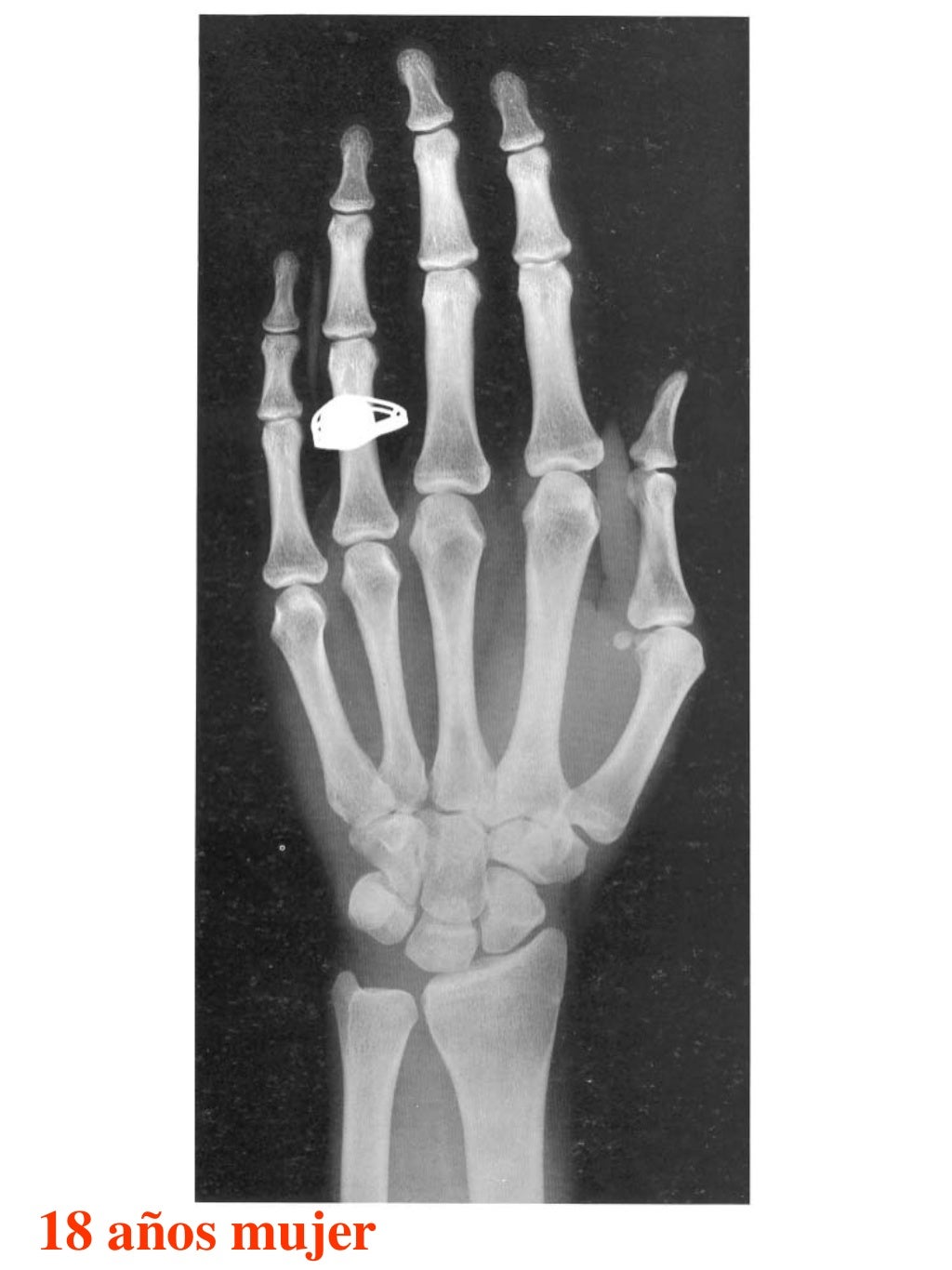 Atlas greulich y pyle