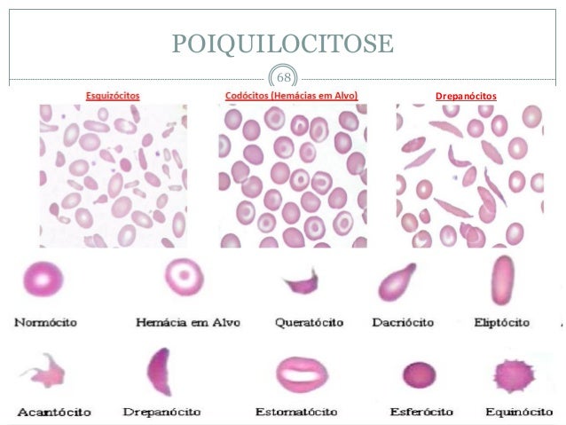 Atlas hematologico alterações hematologicas
