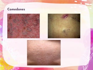 ATLAS LESIONES ELEMENTALES DERMATOLÓGICAS.pdf