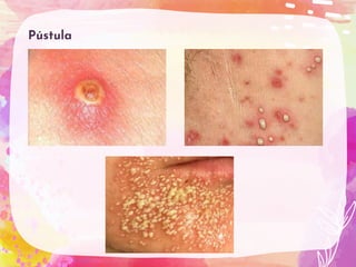 ATLAS LESIONES ELEMENTALES DERMATOLÓGICAS.pdf