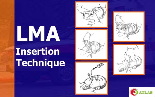 Laryngeal Mask Airway & Igel - An Introduction