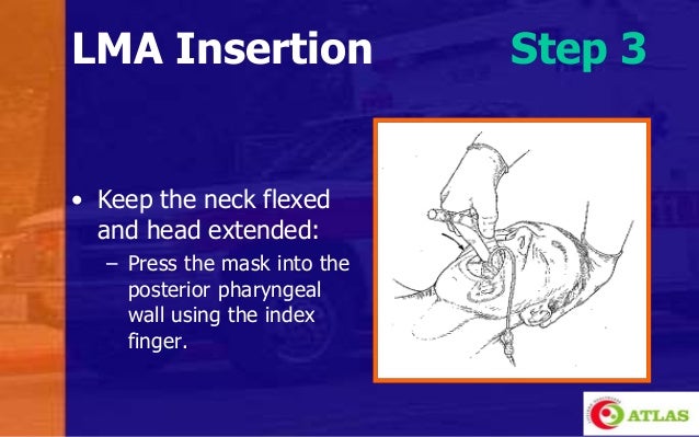 Laryngeal Mask Airway & Igel - An Introduction