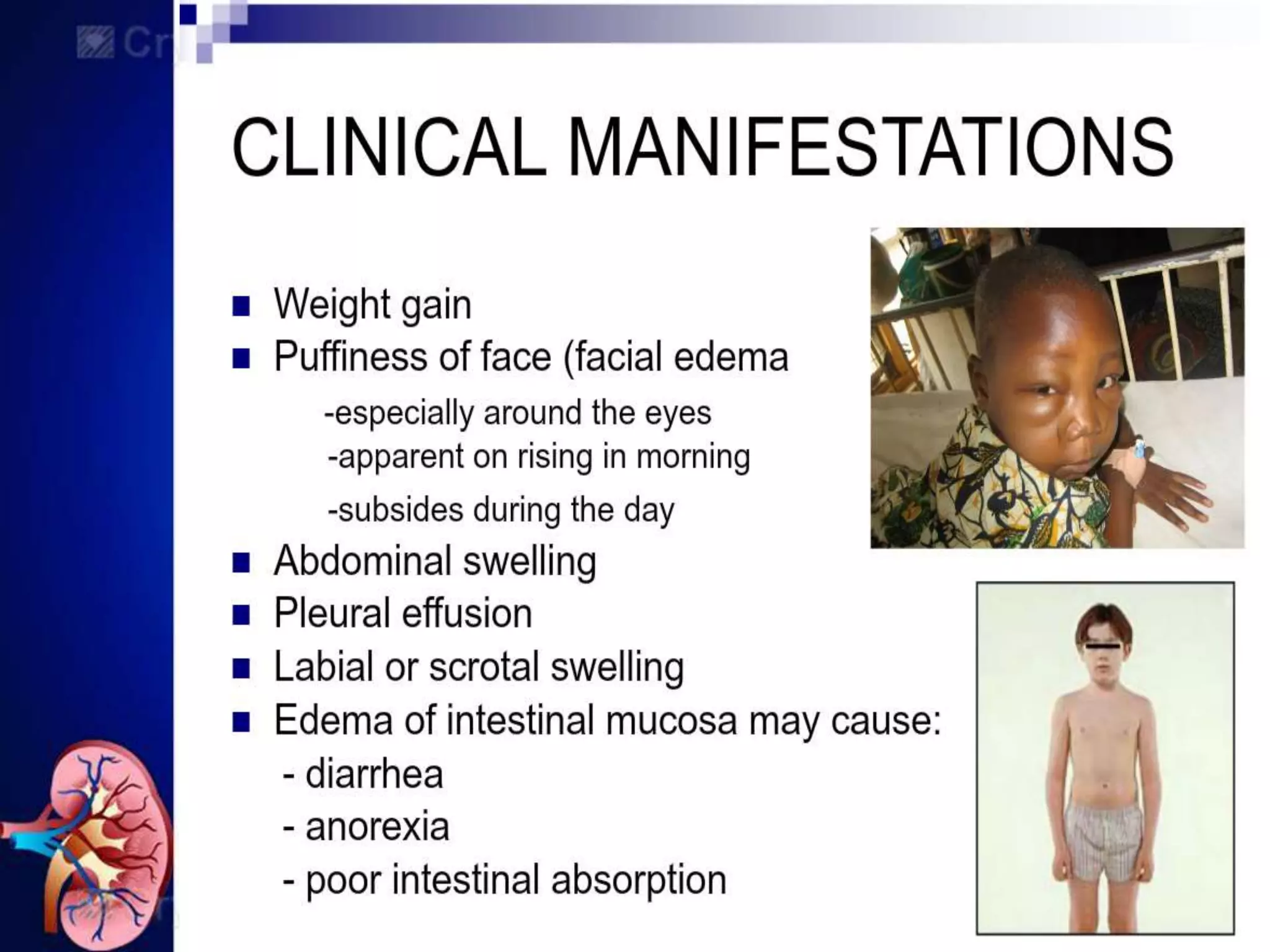 Nephrotic Syndrome | PPTX
