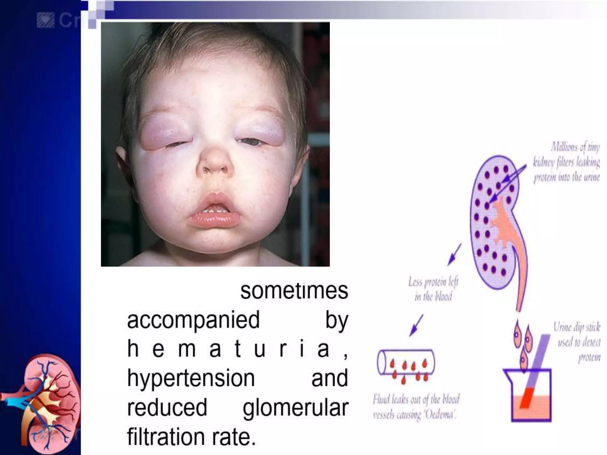 Nephrotic Syndrome | PPTX
