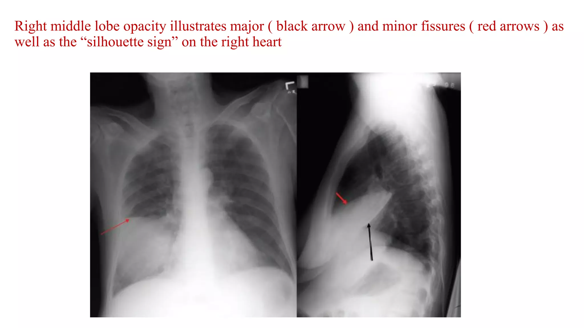 Atlas of chest imaging | PPT