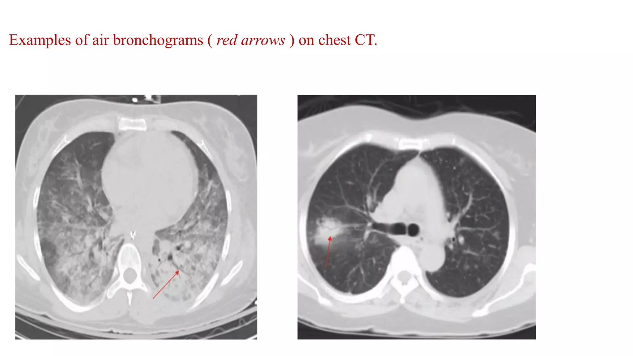 Atlas of chest imaging | PPT