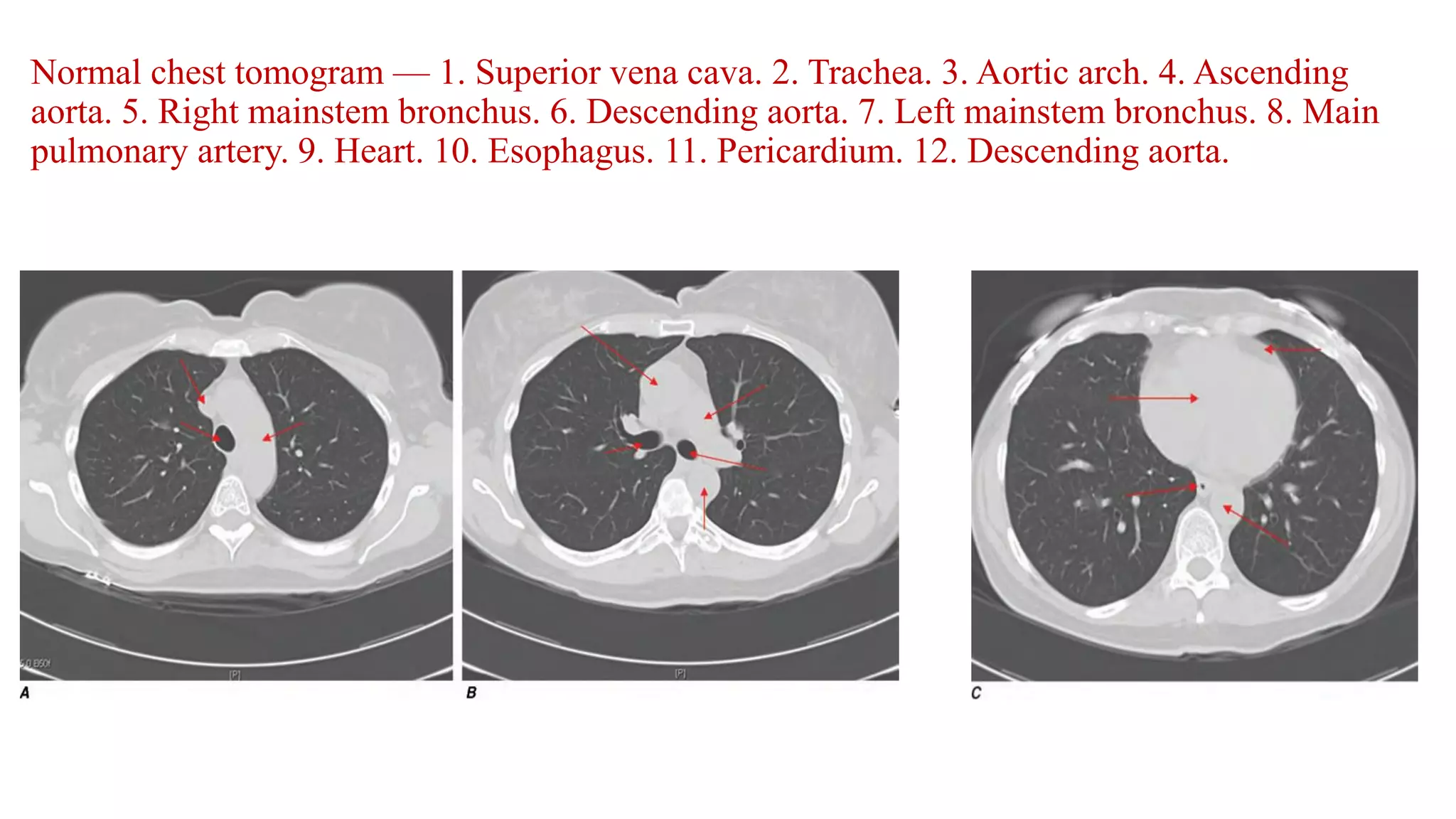 Atlas of chest imaging | PPT