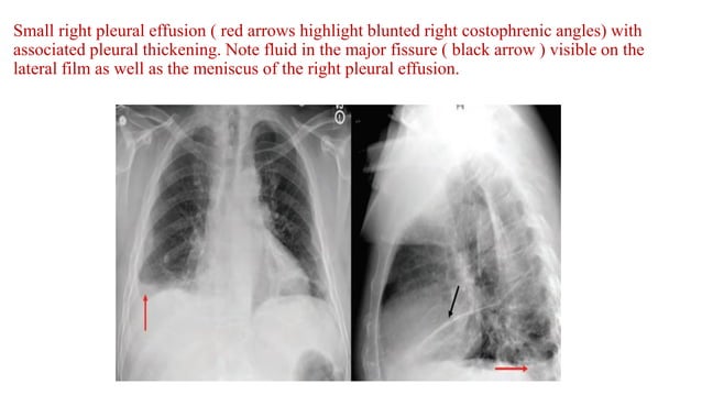 Atlas of chest imaging | PPT