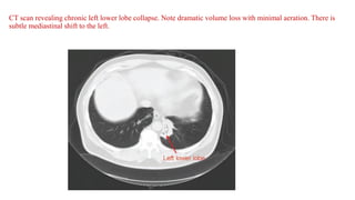 Atlas of chest imaging | PDF