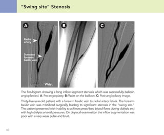 Atlas of dialysis vascular access | PDF